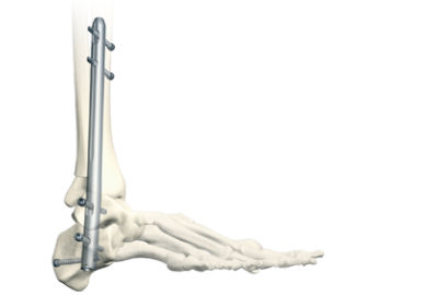 T2 Ankle Arthrodesis | Stryker